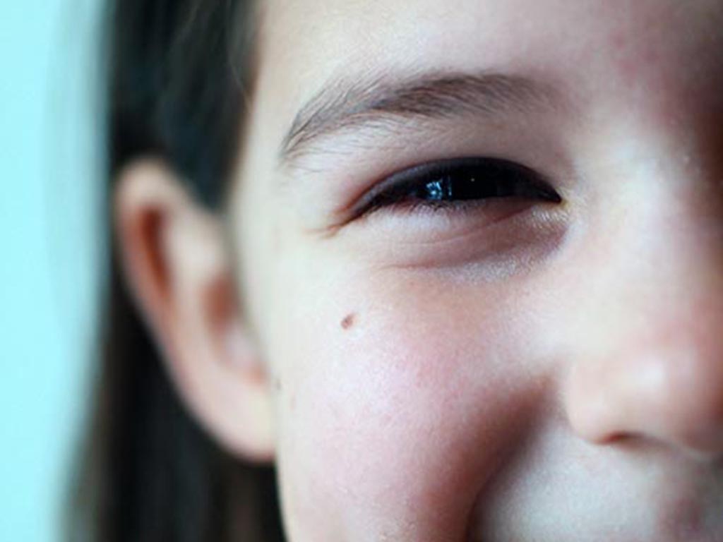 Usher syndrome (USH) | CERA